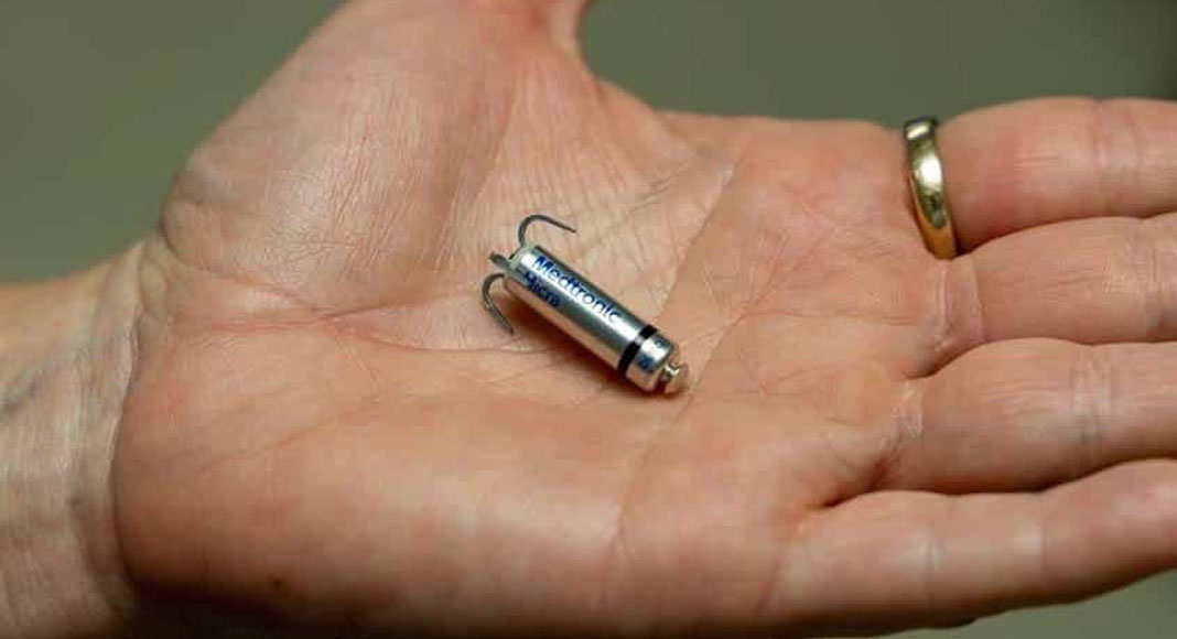 Sin cables y de titanio puro: ya se usa en la Argentina el marcapasos ...